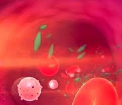 La septicémie/sepsis, une réponse généralisée à une infection grave ...